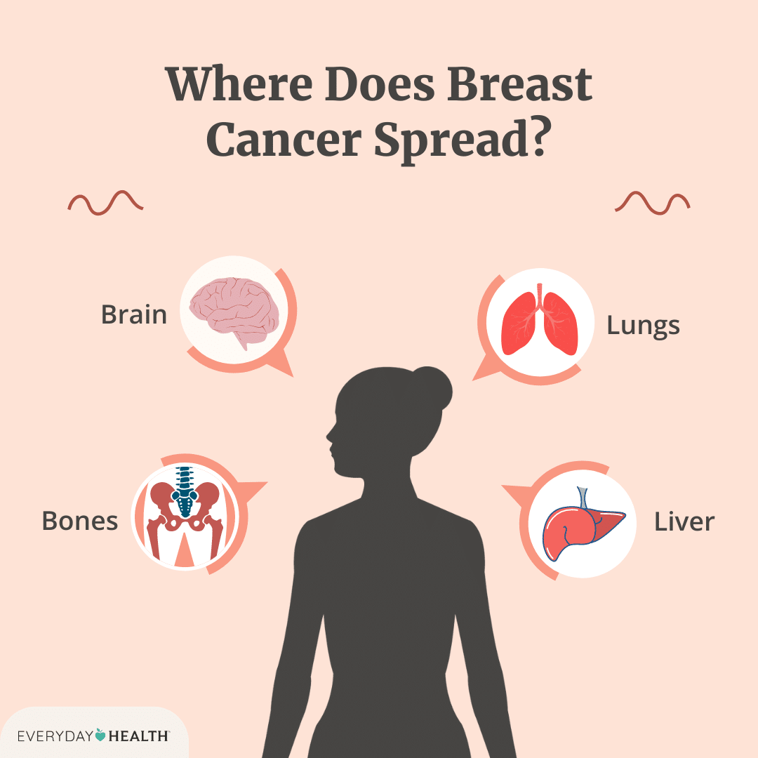 How Breast Cancer Spreads and Recurs - Med to Care
